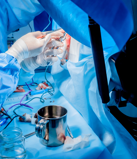 Colon Diverticulitis, Robotic Surgery for Diverticulitis Fort Lauderdale