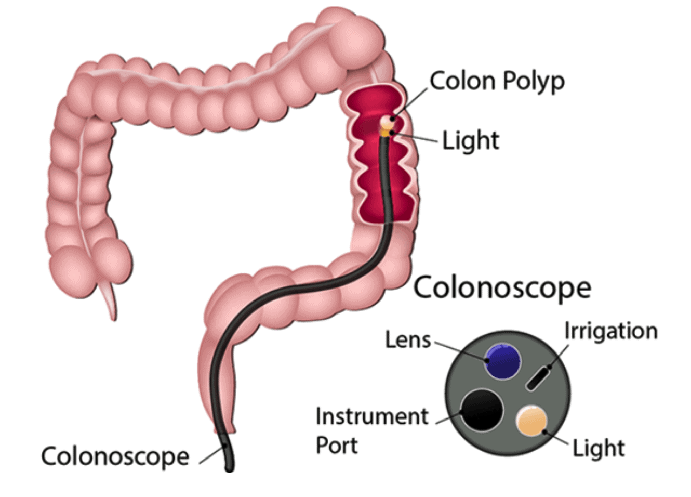 colonoscopy screening the colon and rectum