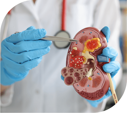 Hemorrhoids South Florida Treatment Cyst Bath, Hemorrhoidectomy