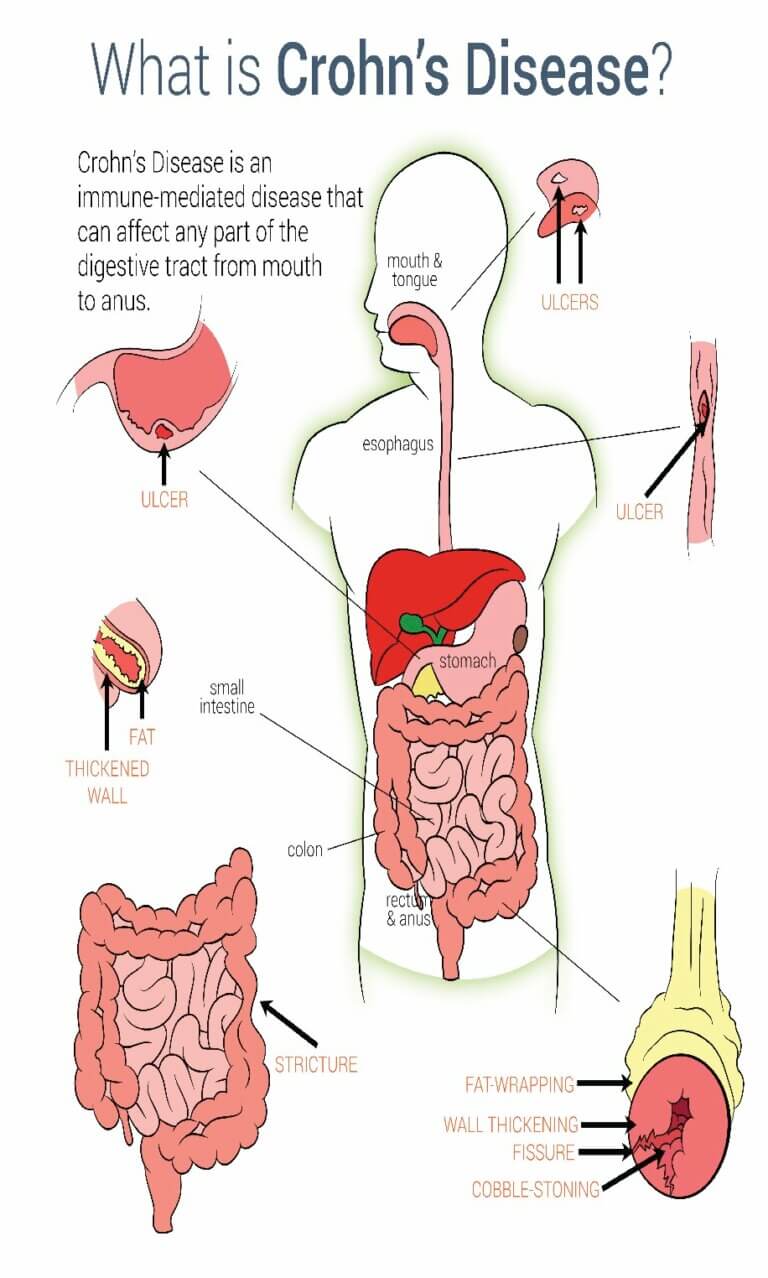 Crohns Disease Broward County Florida