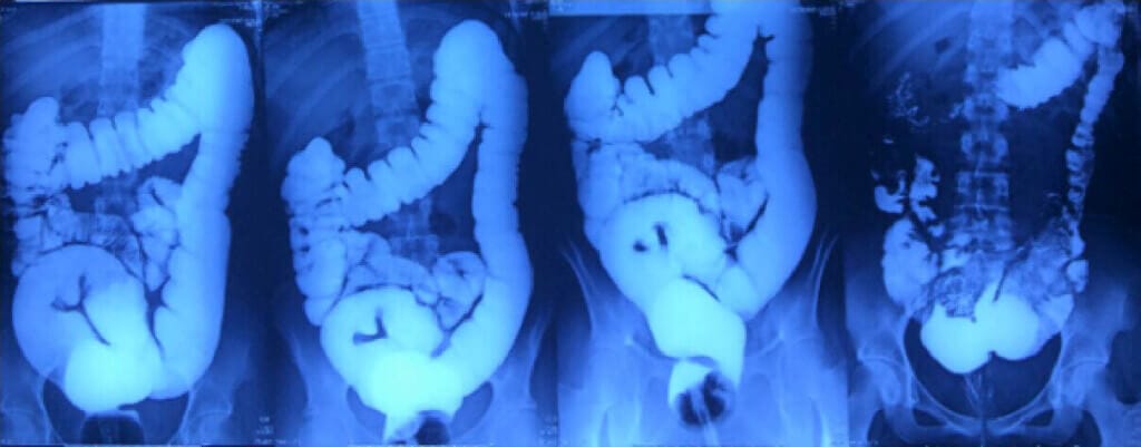 Severe Constipation Chronic Constipation In Broward County, FL